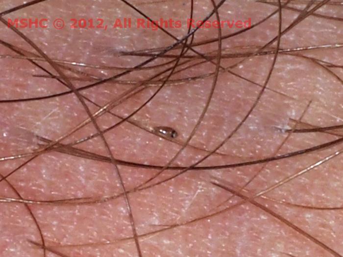 Pubic Lice Crabs Red Book Online Pubic Lice Crabs Red Book Online